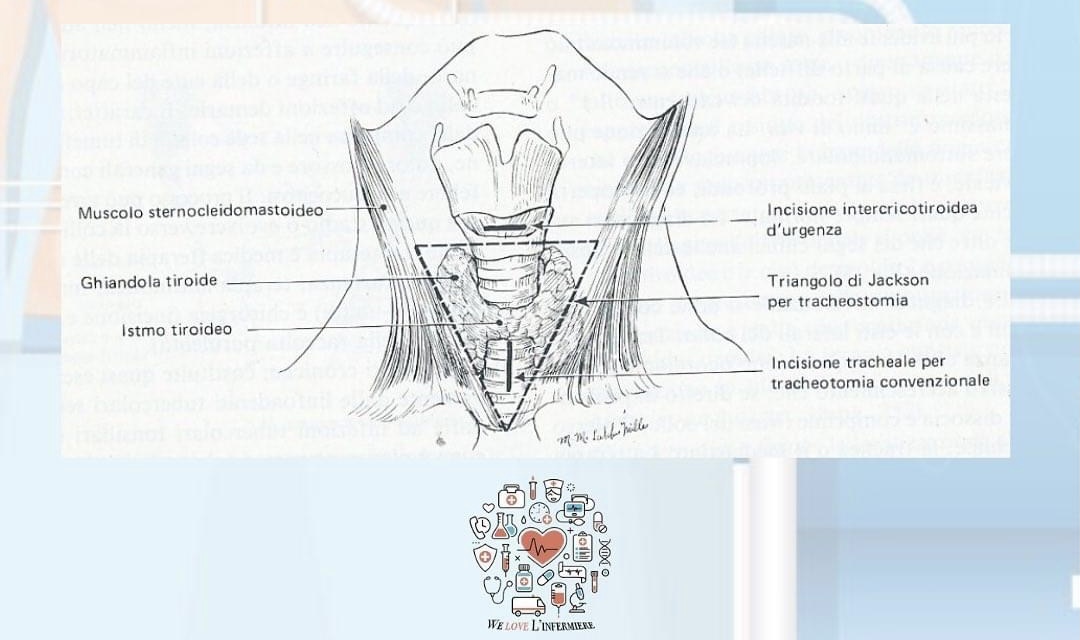 TRACHEOSTOMIA :: We love l’infermiere